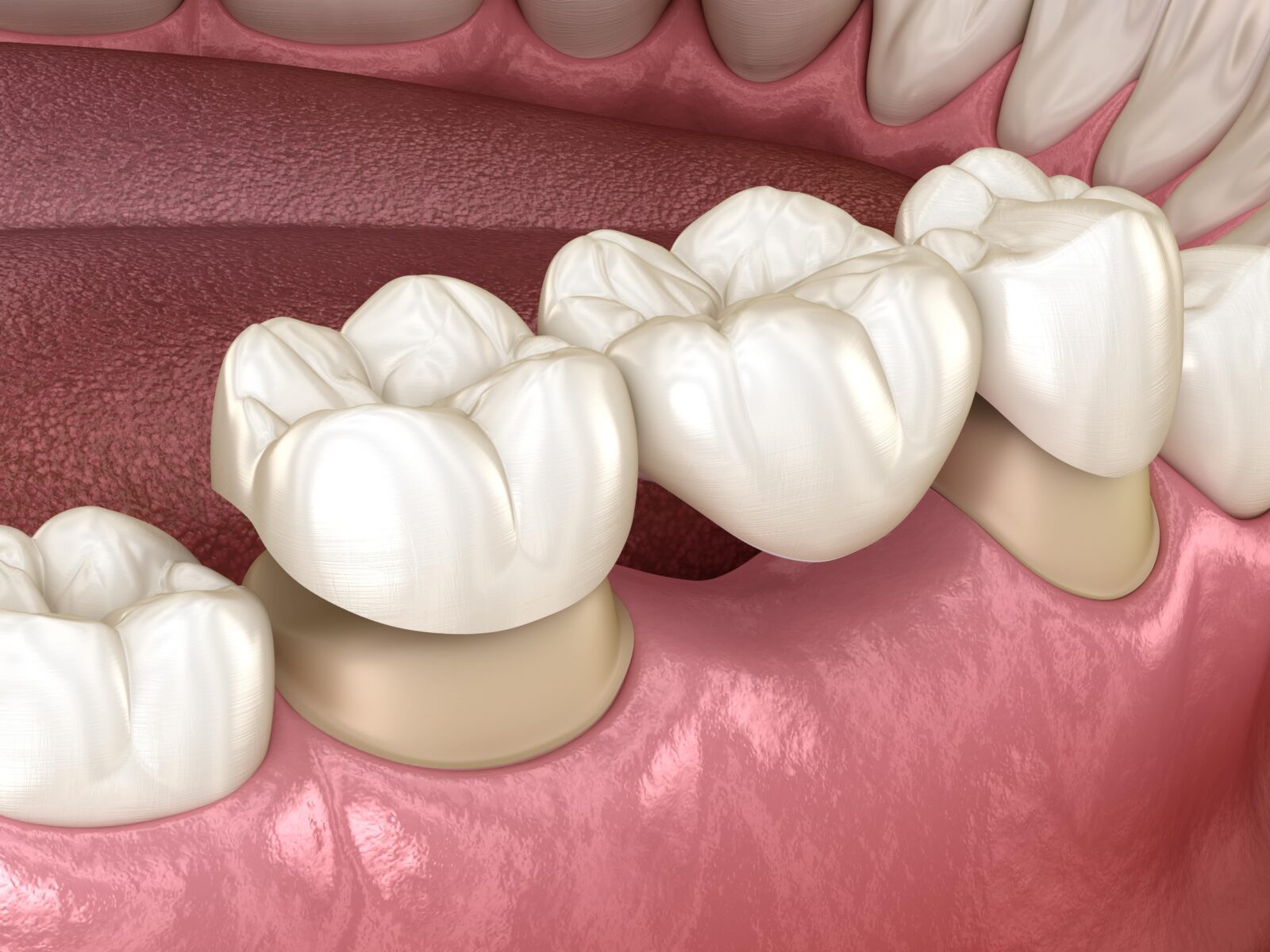 How to Care for Your Dental Bridge | Expert Tips from Lethbridge Dentist
