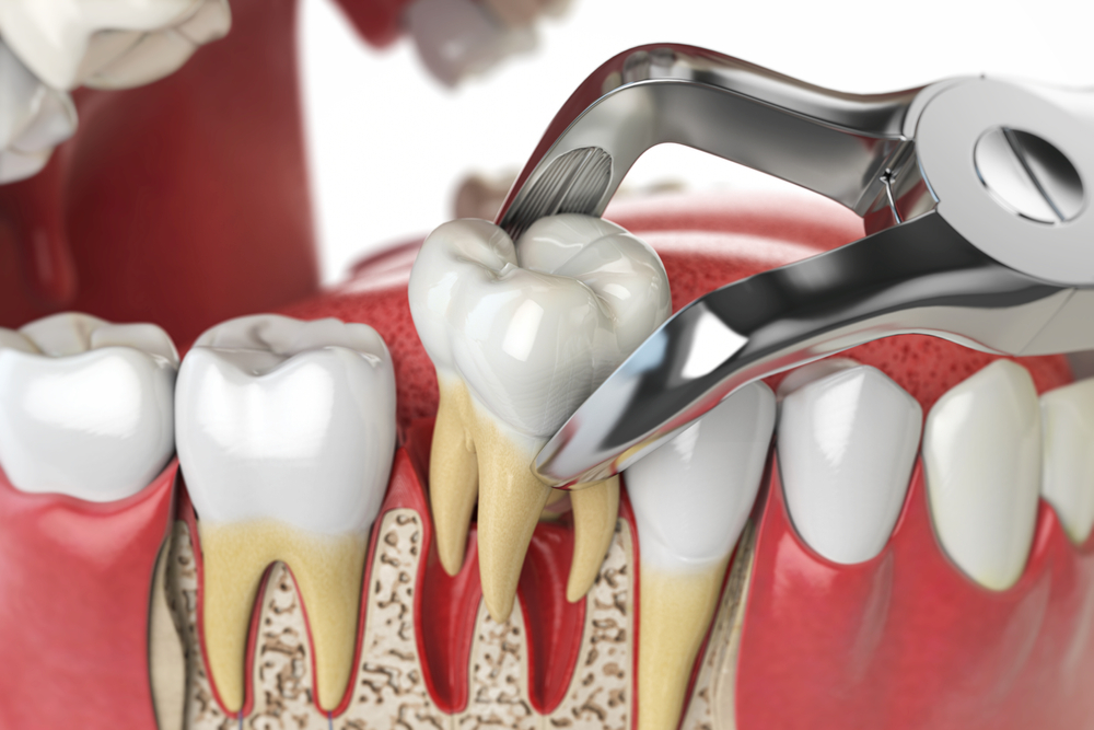 Simple vs Surgical Tooth Extractions: What’s the Difference?